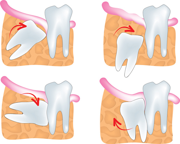 Get Wise on Wisdom Teeth - Sedaros Oral Surgery
