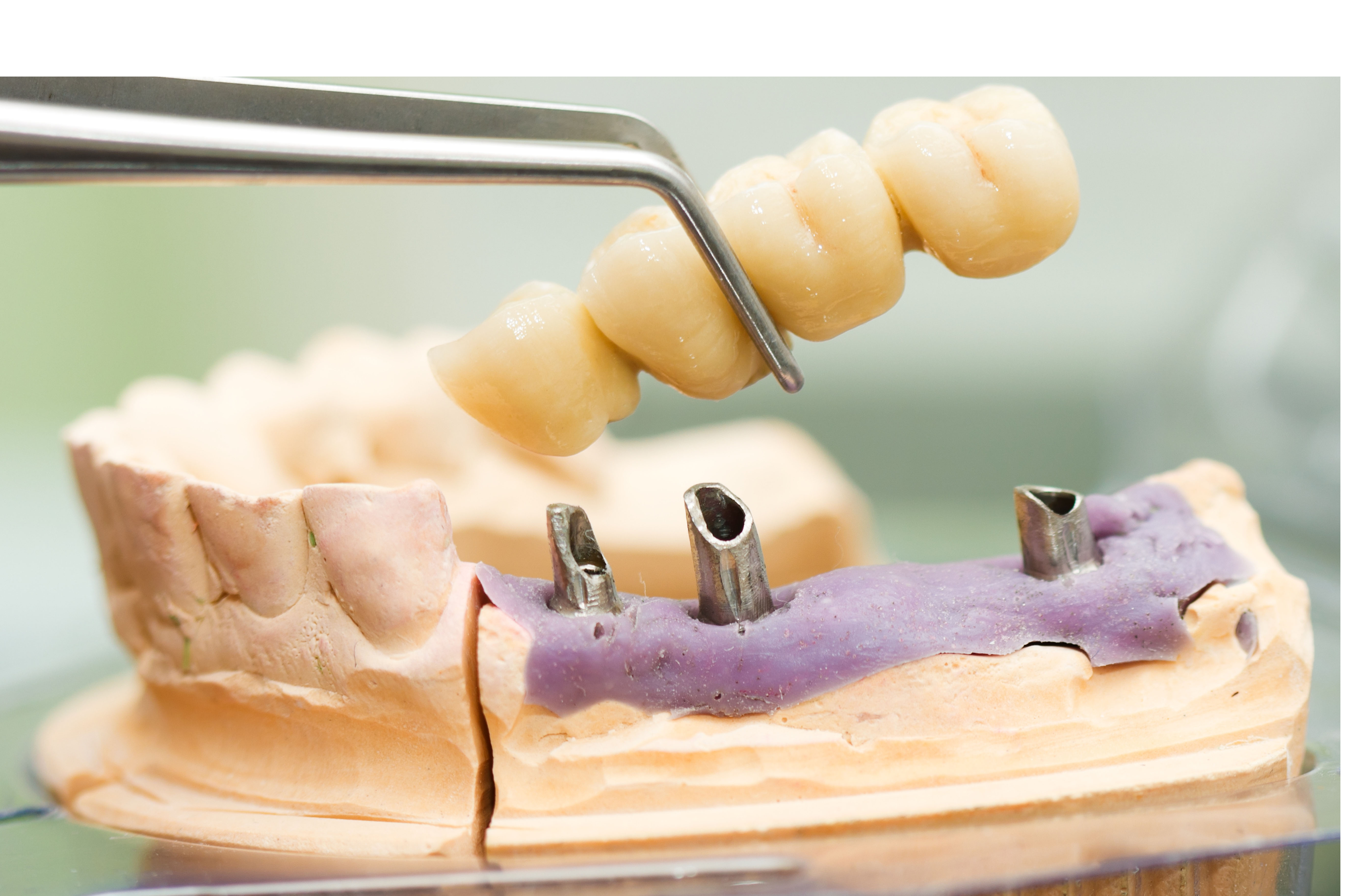 Protective Features of Fixed Prosthodontics - Sedaros Oral Surgery