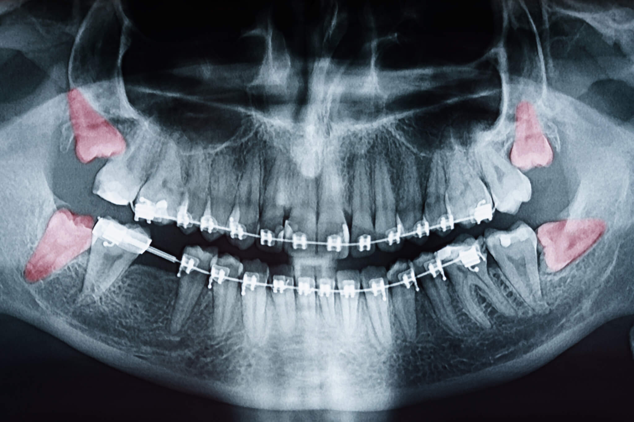 What Can Happen If I Leave My Impacted Canine Tooth