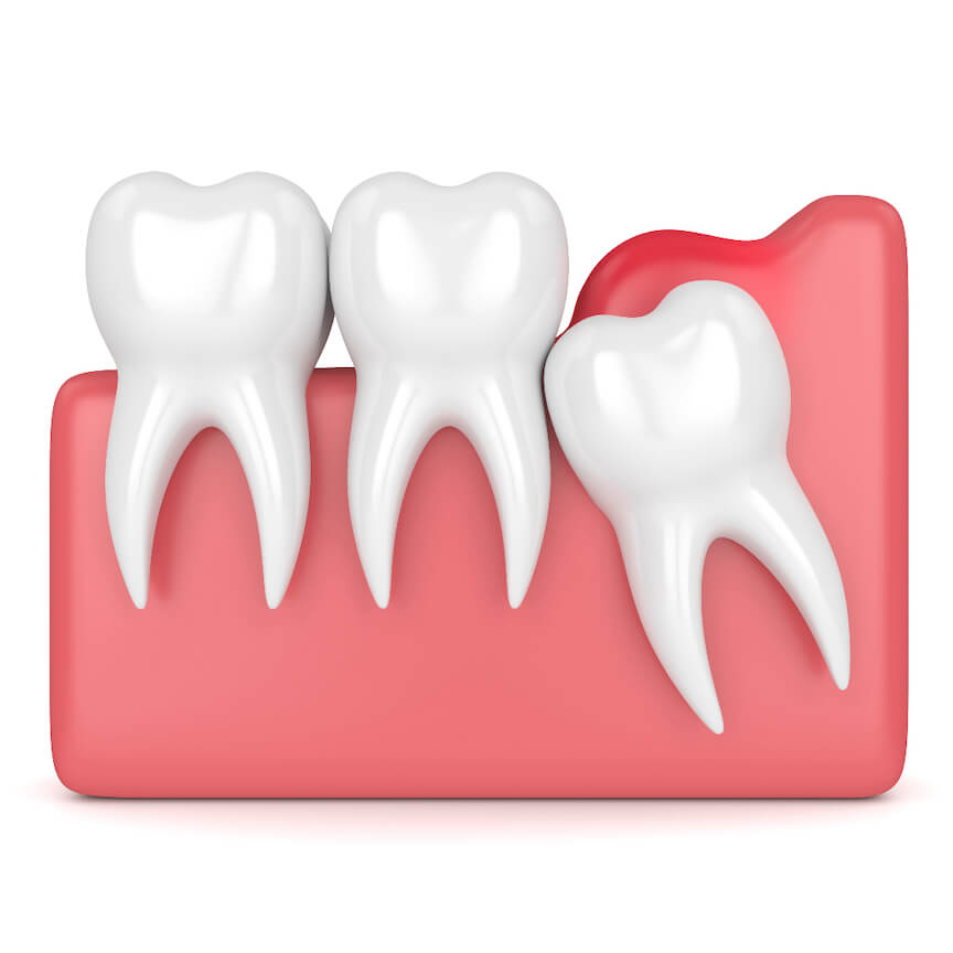 Wisdom Teeth Removal: What You Should Know