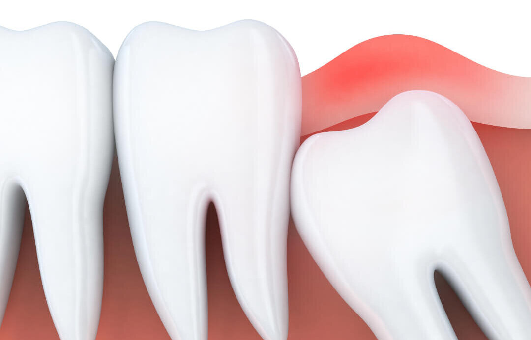 Understanding Wisdom Teeth Removal: What to Expect